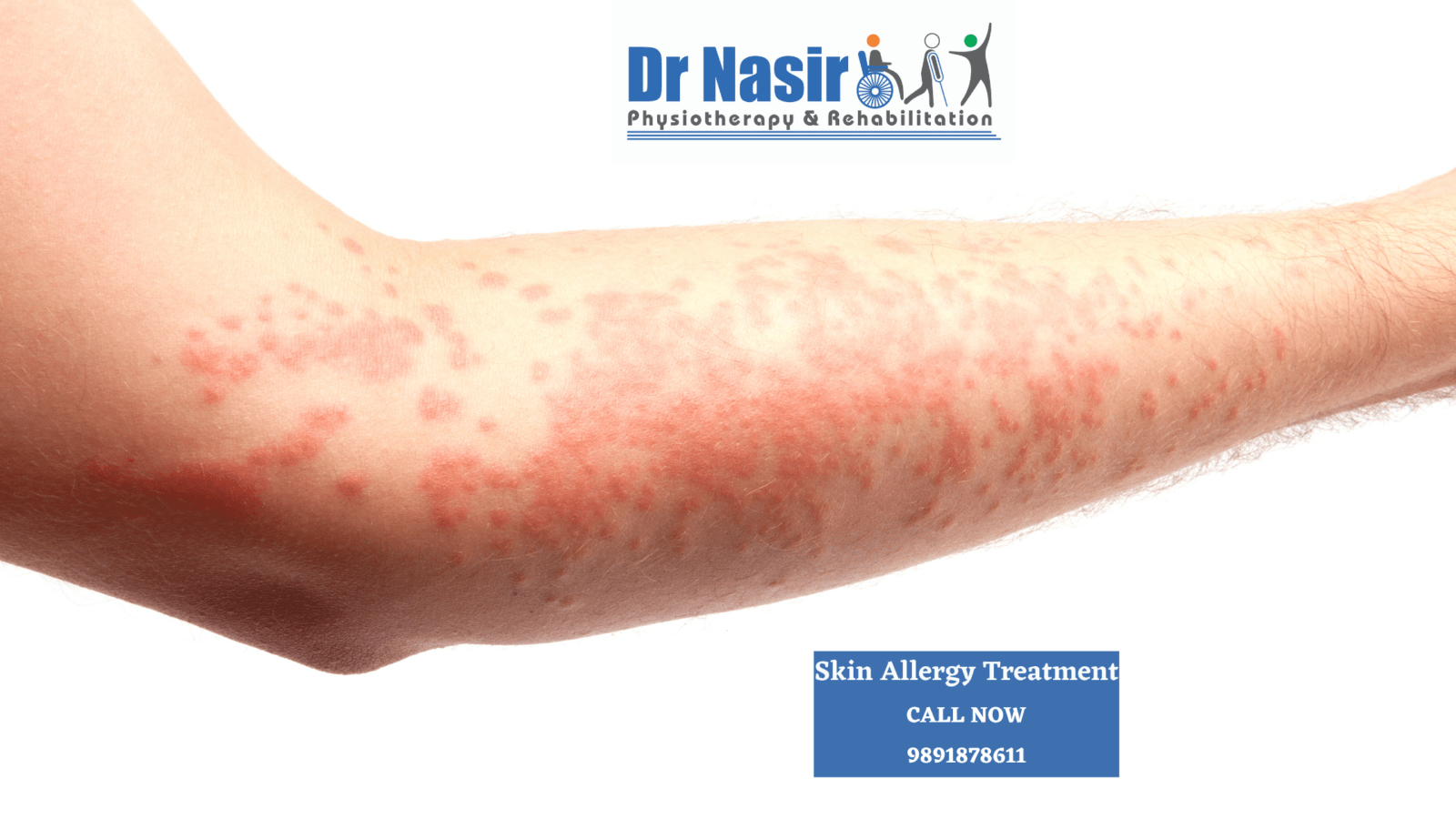 Skin Allergy Treatment In Vikaspuri Tilak Nagar Janakpuri Rajouri Garden skin-allergy-treatment-in-vikaspuri-tilak-nagar-janakpuri-rajouri-garden